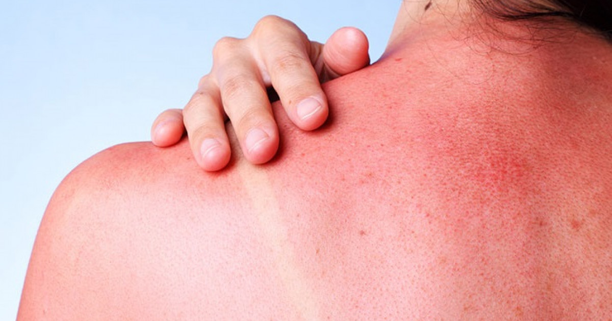 Expertos advierten que la ola de calor puede causar enfermedades como ...